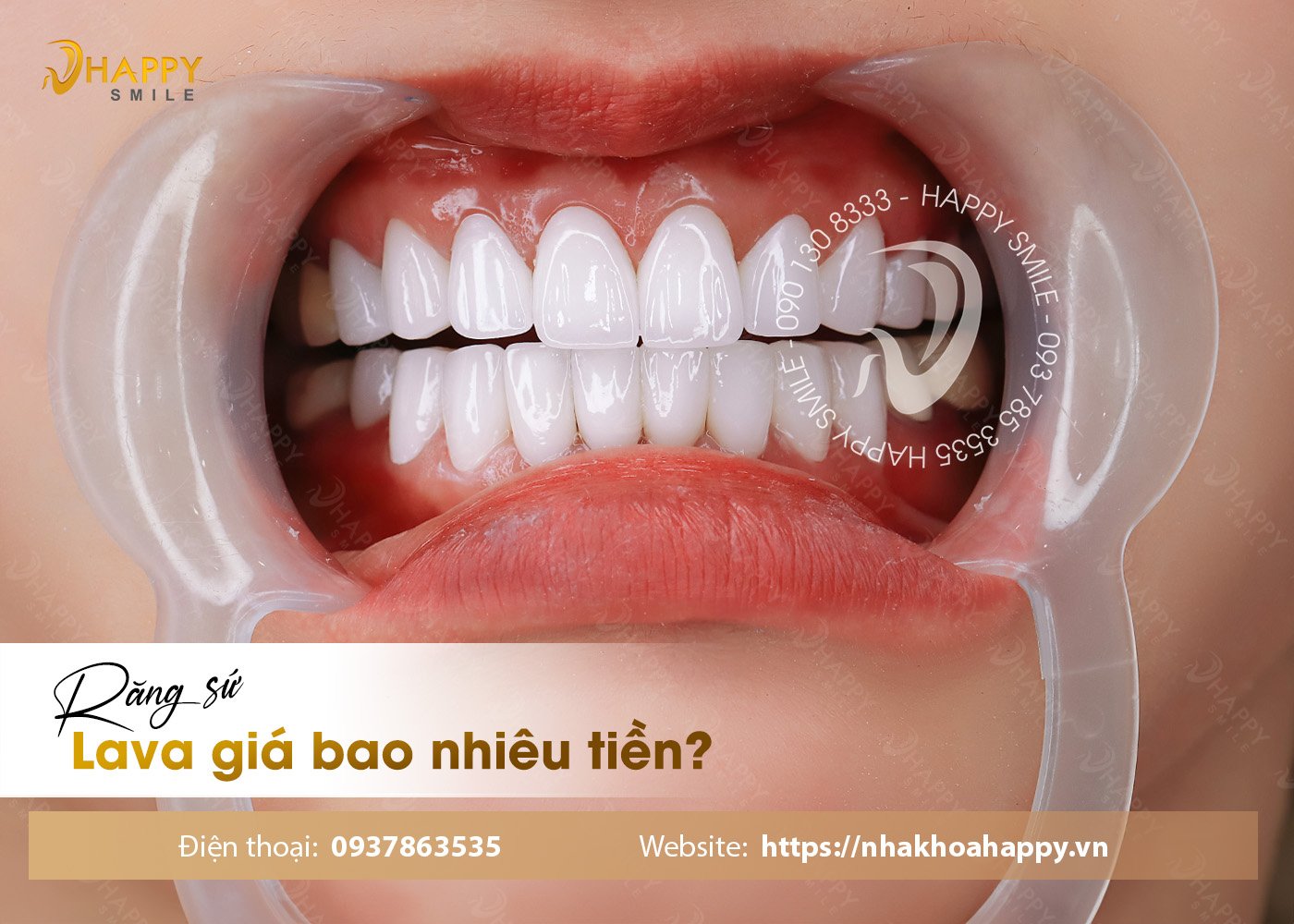 Răng sứ Lava Plus 3M giá bao nhiêu tiền 1 răng - Nha Khoa Happy Smile