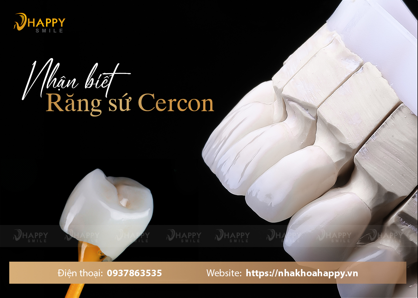 Cách nhận biết răng sứ Cercon chính hãng - Nha Khoa Happy Smile